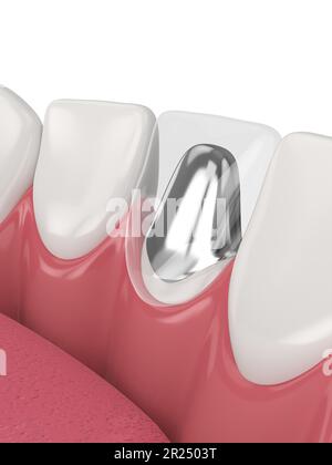 3d render of lower jaw with cast post and core tooth restoration over ...