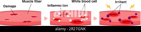 Mechanism of muscle soreness vector illustration Stock Vector Image ...