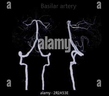 CTA BRAIN or CT angiography of the brain showing basilar artery Stock ...