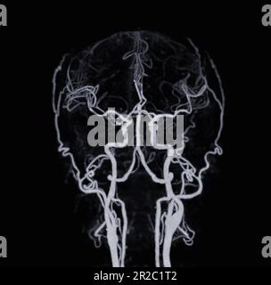CT angiography of the brain or CTA brain showing Cerebral artery Stock ...