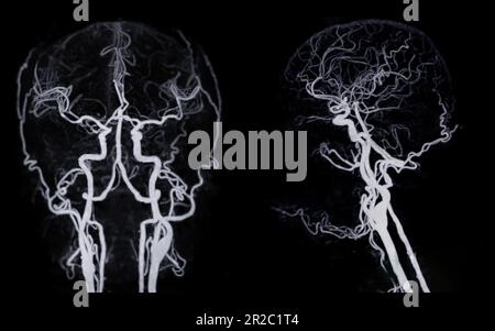 CT angiography of the brain or CTA brain showing Cerebral artery Stock ...