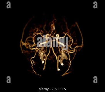 CT angiography of the brain or CTA brain showing Cerebral artery Stock ...