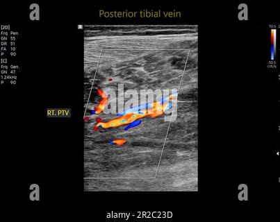 Color Doppler ultrasound determination in deep vein thrombosis patients ...