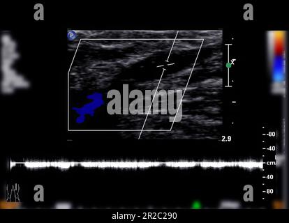 Color Doppler ultrasound determination in deep vein thrombosis patients ...