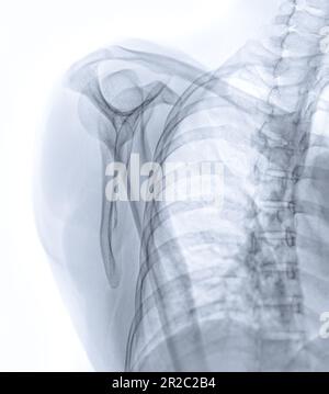 Normal shoulder joint, X-ray Stock Photo - Alamy