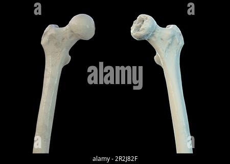 Legg-Calve-Perthes disease, illustration Stock Photo - Alamy