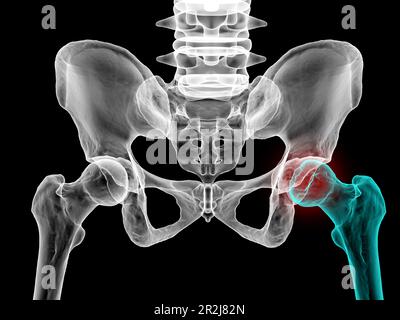 Legg-Calve-Perthes disease, illustration Stock Photo - Alamy
