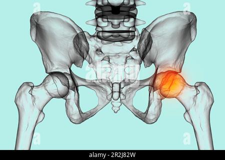 Legg-Calve-Perthes disease, illustration Stock Photo - Alamy