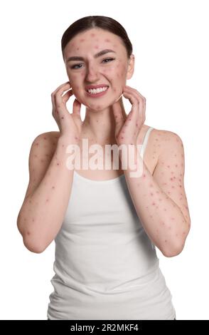 Woman with rash suffering from monkeypox virus on white background ...