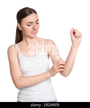 Woman with rash suffering from monkeypox virus on light grey background ...