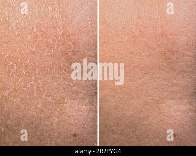 Collage demonstrating comparison of dry and moisturized human skin ...