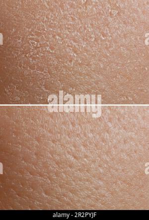 Collage demonstrating comparison of dry and moisturized human skin ...