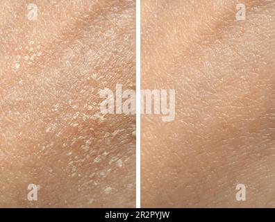 Collage demonstrating comparison of dry and moisturized human skin ...
