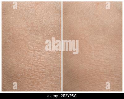 Collage demonstrating comparison of dry and moisturized human skin ...