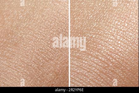 Collage demonstrating comparison of dry and moisturized human skin ...