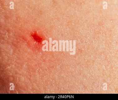 Wound after the removal of a wood tick Stock Photo - Alamy