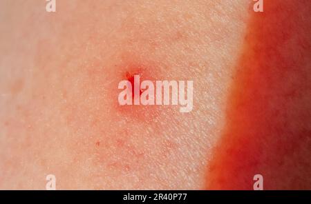 Wound after the removal of a wood tick Stock Photo - Alamy
