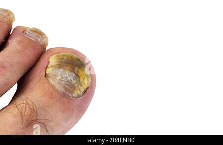 Close-up of all male foot thumbnail, fungal nail in blue background ...