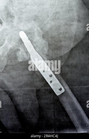 Left hip trans cervical neck of femur fracture fixated by DHS Dynamic ...