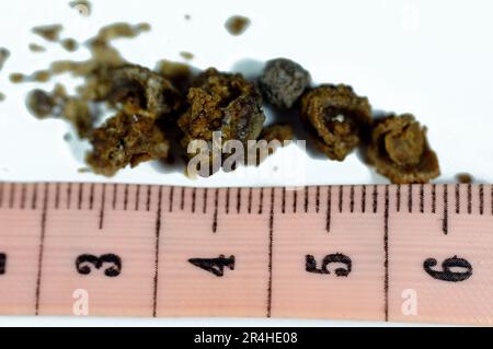 Nephrolithiasis, irregular brown kidney stones (renal calculus or ...