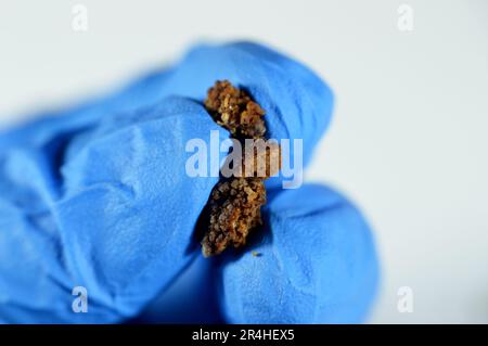 Nephrolithiasis, irregular brown kidney stones (renal calculus or ...