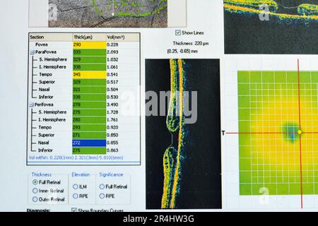 OCT of the eye reveals faint epimacular membrane and full thickness ...
