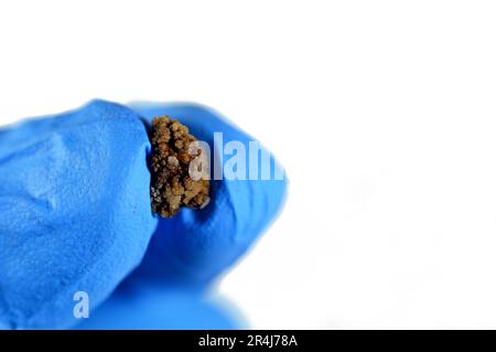 Nephrolithiasis, irregular brown kidney stones (renal calculus or ...