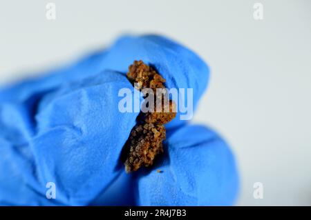 Nephrolithiasis, irregular brown kidney stones (renal calculus or ...