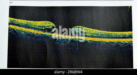 OCT of the eye reveals faint epimacular membrane and full thickness ...
