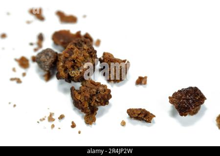 Nephrolithiasis, irregular brown kidney stones (renal calculus or ...