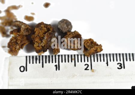 Nephrolithiasis, irregular brown kidney stones (renal calculus or ...