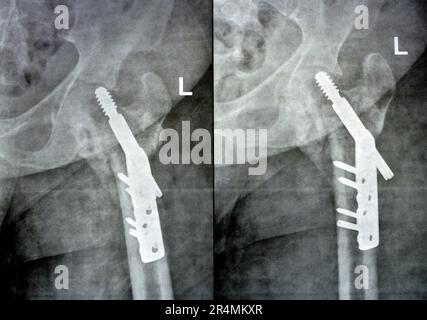 Left hip trans cervical neck of femur fracture fixated by DHS Dynamic ...