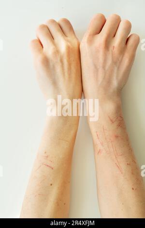 Psoriasis Vulgaris. Skin of a psoriasis patient close-up. Hyperemia ...