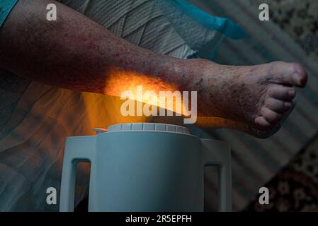 Light therapy given on ulcer (ulcus cruris Stock Photo - Alamy