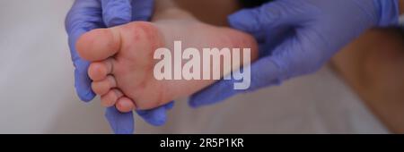 Rash with enterovirus infection of the picornavirus family on feet of ...