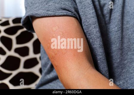 Skin rash and swelling on man arm, immunizations prevent infectious ...