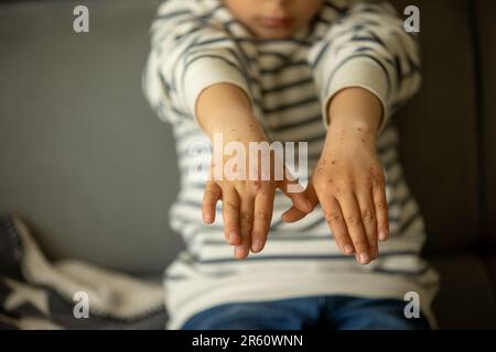 Child with skin rash, roseola, Hand-foot-and-mouth disease, child rash ...
