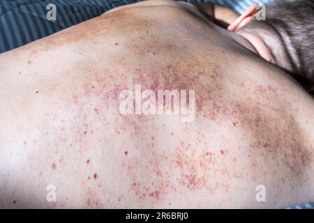 Close up bruises on the back of a man after a massage Stock Photo - Alamy