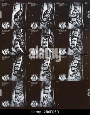 Magnetic resonance imaging. Spinal column detail. Medical procedure ...