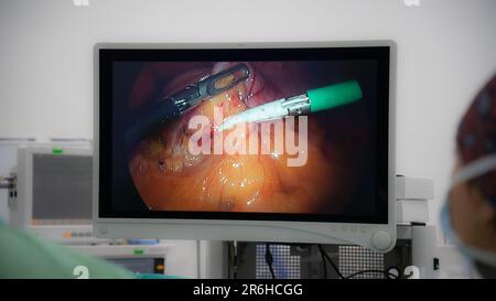 monitor during laparoscopy surgery. Obesity surgery and monitor in the ...