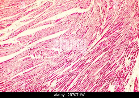 Heart hypertrophy. Photomicrograph showing hypertrophic myocardium with ...