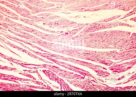 Heart hypertrophy. Photomicrograph showing hypertrophic myocardium with ...