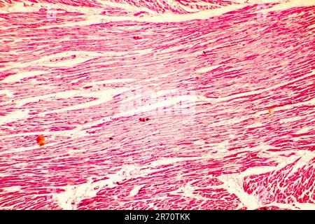 Heart hypertrophy. Photomicrograph showing hypertrophic myocardium with ...