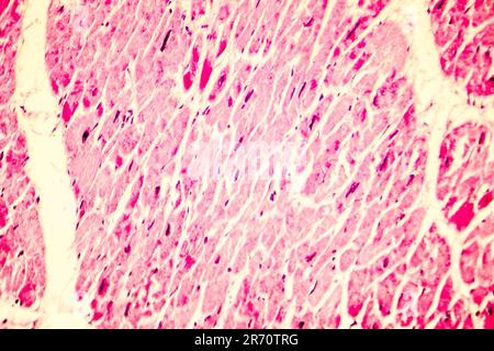 Heart hypertrophy. Photomicrograph showing hypertrophic myocardium with ...
