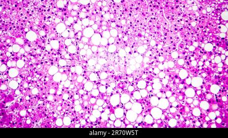 Histopathology of liver steatosis, or fatty liver. Light micrograph ...