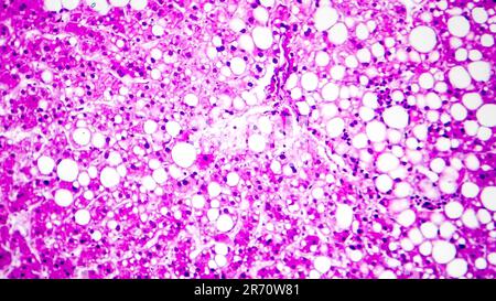 Histopathology of liver steatosis, or fatty liver. Light micrograph ...