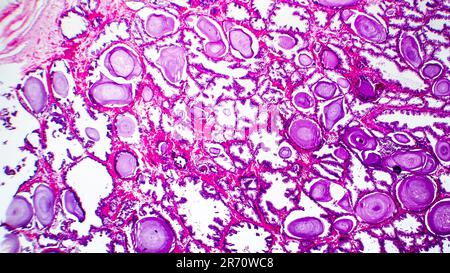Histopathology of prostate gland hyperplasia, light micrograph, photo ...