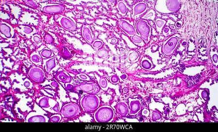 Histopathology of prostate gland hyperplasia, light micrograph, photo ...