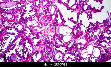 Histopathology of prostate gland hyperplasia, light micrograph, photo ...