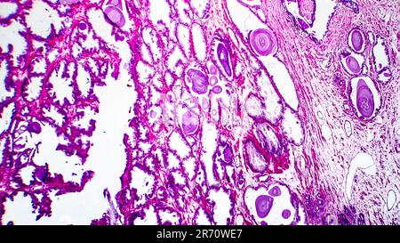Histopathology of prostate gland hyperplasia, light micrograph, photo ...